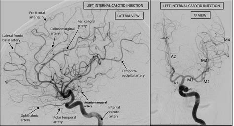 Internal Carotid Artery Segments