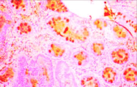 Tf Antigen Immunoreactivity In Adenoma Samples Using Anti Tf Antibody
