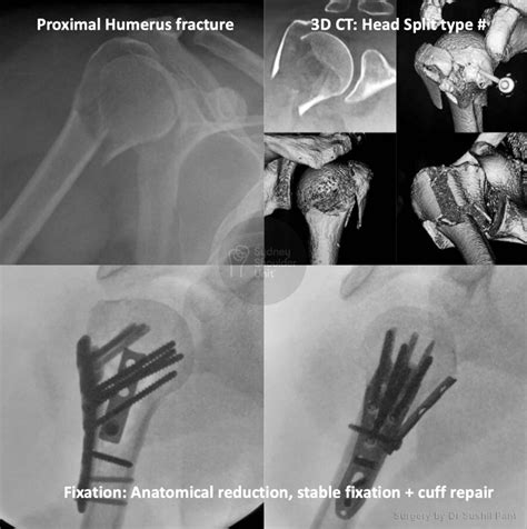 Range Of Motion After Proximal Humerus Fracture At Dianna Wagner Blog