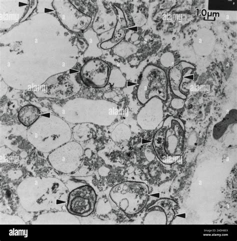 Transmission Electron Micrograph Tem Of A Section Of Lung Tissue From