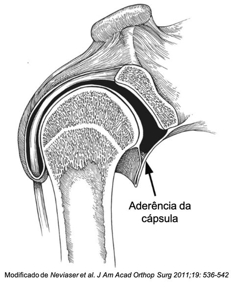 Ombro Congelado Capsulite Adesiva Diagnóstico E Tratamento
