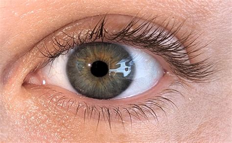 Central Heterochromia Reyes