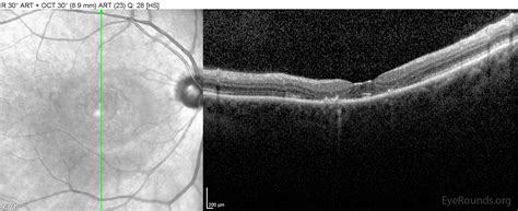 Bulls Eye Maculopathy Due To Hydroxychloroquine Toxicity