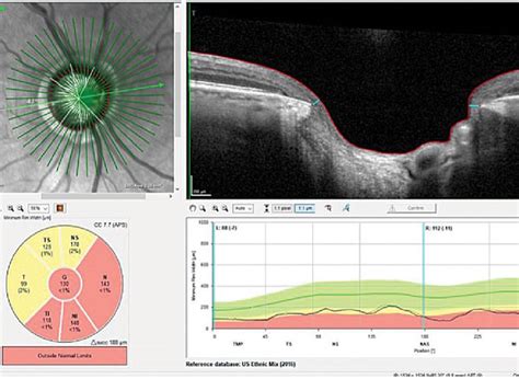 Advancing Toward Advanced Disease