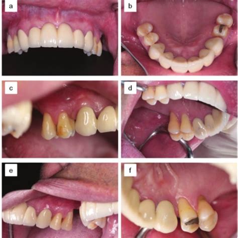 Visual Assessment Scale The Tool Used To Score Severity Of Pd Download Scientific Diagram