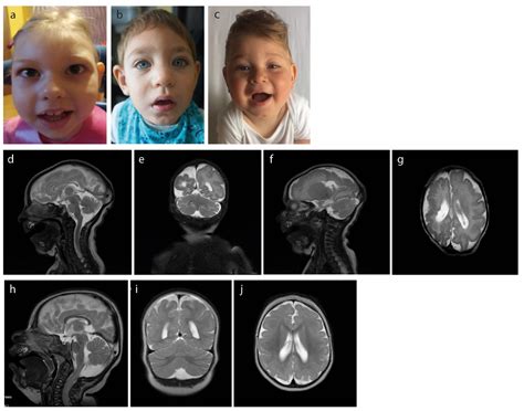 Further Delineation Of Phenotype And Genotype Of Primary Microcephaly