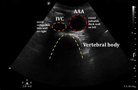 Aortic Aneurysm Ultrasound Size
