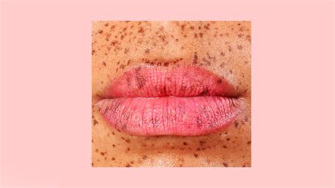 Chapped Lips Bumps