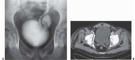 The Urinary Bladder Radiology Key