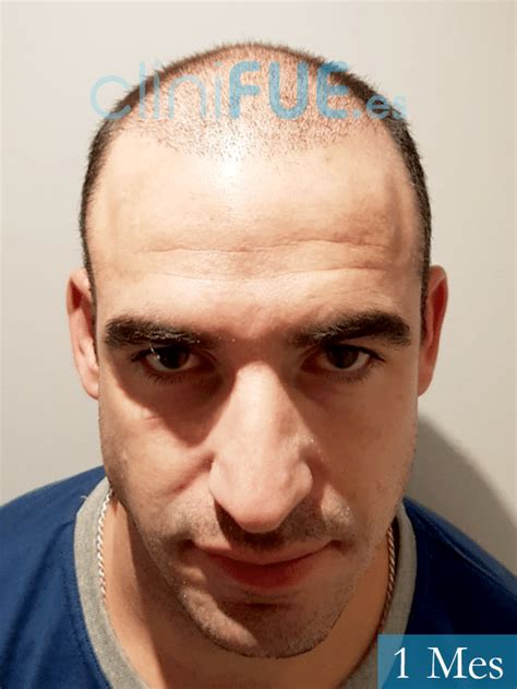 Injerto Capilar De Mario 30 Años De La Roja Con Clinifue