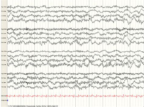 Normal Eeg Neupsy Key