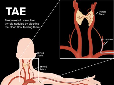 Thyroid Artery Embolization Tae Expert Treatment At Nsvi