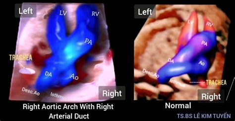 Long Bạch Hải On Linkedin Right Sided Aortic Arch With Right Ductus