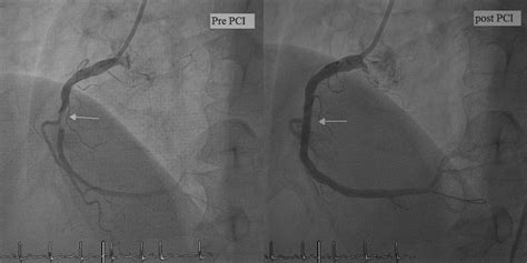 Acs And Stemi Systems Of Care Acls Resources Acls Certification