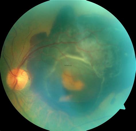 Type 1 Macular Neovascularization Complicated With Rpe Tear And
