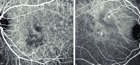 Measurement Of Hyperpermeable Choroidal Lesion Size We Measured The