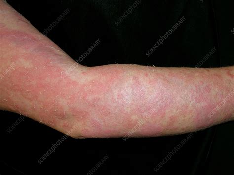 Erythrodermic Psoriasis Stock Image C0565503 Science Photo Library