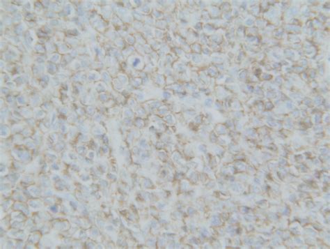 Case 2 Biopsy Cd20 Stain Cd20 Positive Staining Of Cells Consistent