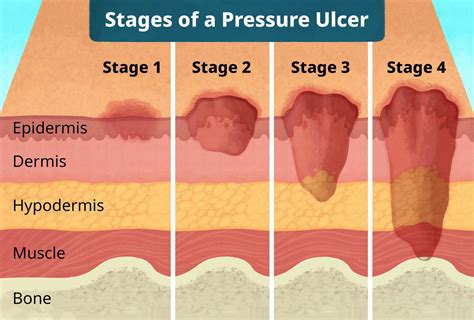 Derm Index Lets Learn About Pressure Ulcers Pressure Ulcers Also Referred To As Bedsores Or