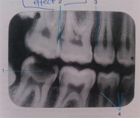 Radiographic Caries Detection Foundations Flashcards Quizlet