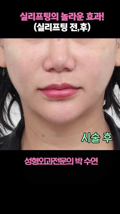 실리프팅의 놀라운 효과 실리프팅전후 올리고당 실리프팅박수연원장 Youtube