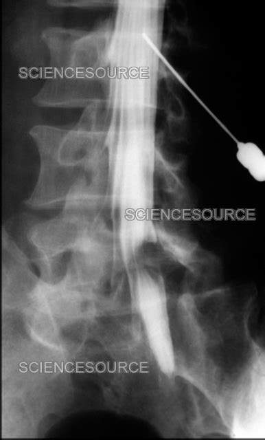 Myelogram Herniated Discs