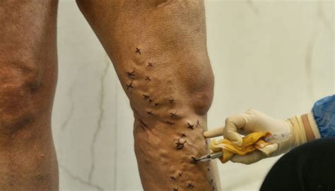 مراقبت‌ها و نكات مهم بعد از درمان واریس طنابی دکتر مهرداد اقدسی