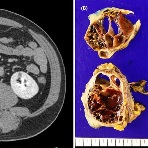 Preoperative Contract Ct Scans Of Cystic Renal Tumor And Gross Picture