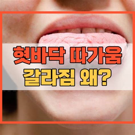 혓바닥 따가움 갈라짐 왜 이럴까요