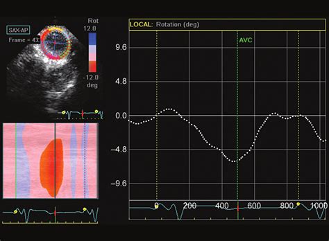 Reversed Apical Rotation In Patient Of Dilated Cardiomyopathy