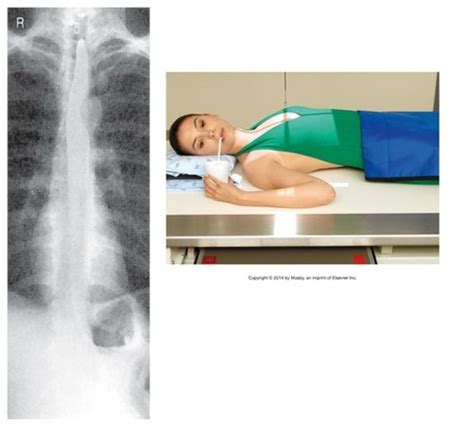 Esophogram Flashcards Quizlet