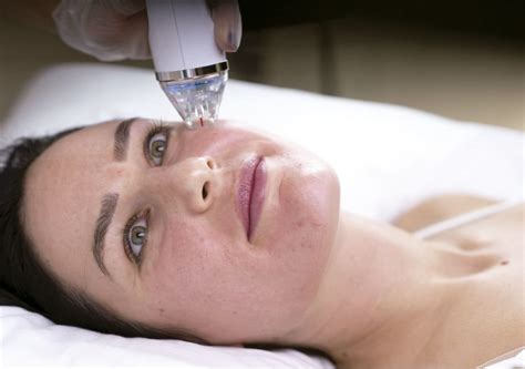 Radiofrecuencia Fraccionada Con Microagujas Endymed Intensif