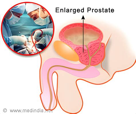 Enlarged Prostate Gland Male Reproductive System Pinterest