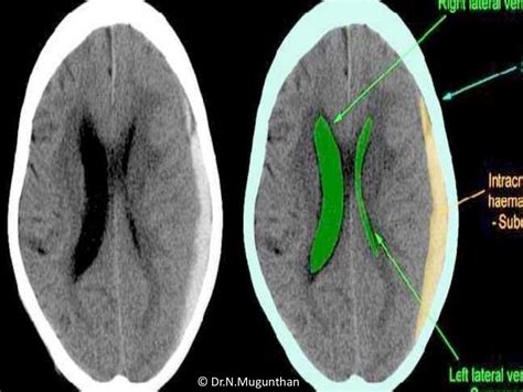 Lateral Ventricle Of Brain By Drnmugunthanms