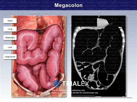 Megacolon