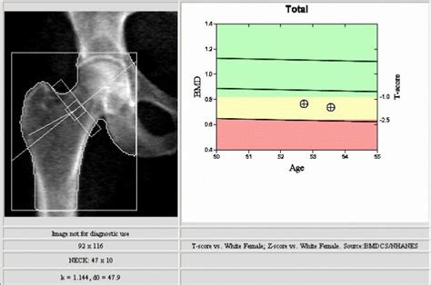 Female Bone Density Chart Ponasa