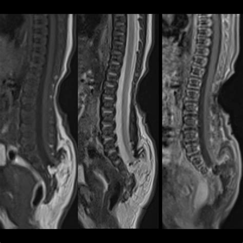 Lipomyelomeningocele Pediatric Radiology Reference Article