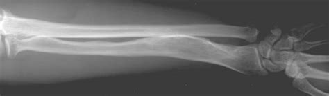 Osteochondroma Radiology Orthopaedicsone Images