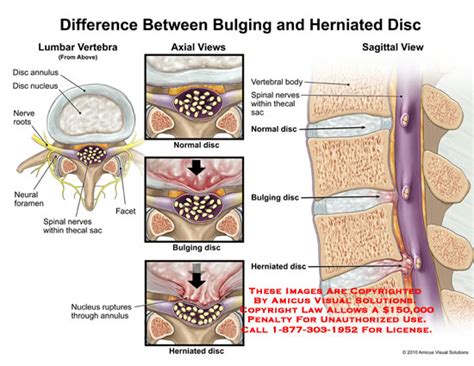 Bulging Disc Vs Herniated Disc Whats The Difference