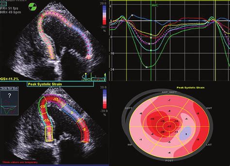 Ste In A Patient With Cardiac Amyloidosis Shows Decreased Global Download Scientific Diagram