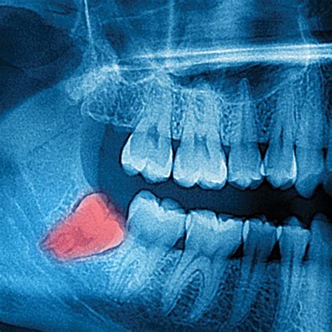 Are Wisdom Teeth Evidence For Evolution Wisdom Teeth Dental Implants Cost Teeth Whitening