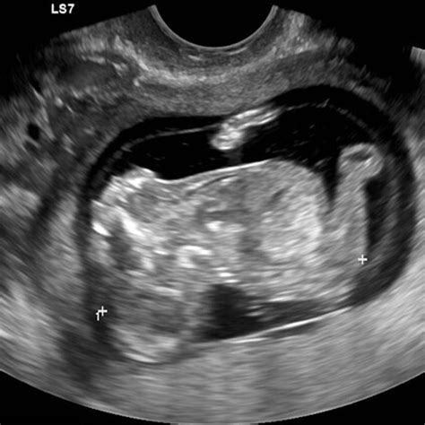 Acraniaexencephalyanencephaly Aeas A Case Study