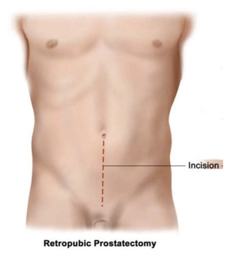 Prostatectomy Open Radical — Urology Care Toowoomba Dr Nikhil Sapre Urologist