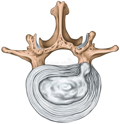 Lumbar Disk Herniation Stock Illustration Illustration Of Fibrous