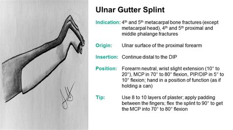 Ulnar Gutter Aliem