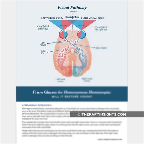 Prism Glasses For Homonymous Hemianopia Will It Restore Vision