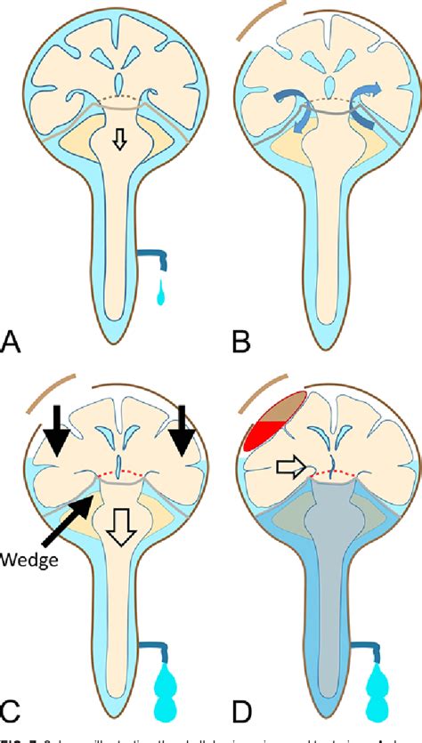 Figure 7 From Risk Of Brain Herniation After Craniotomy With Lumbar Spinal Drainage A