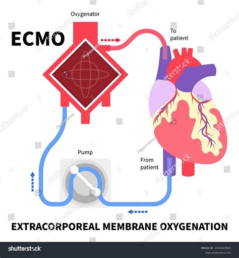 Heart Bypass Life Support System Extracorporeal Stock Vector Royalty
