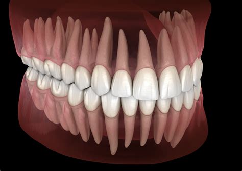 7 Possible Causes Of Translucent Teeth And How To Fix Them