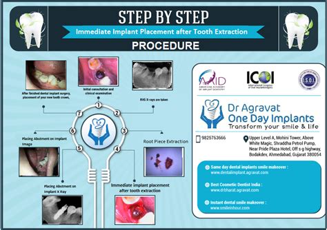 Dental Implant 20 Years After Extraction At Paula Roche Blog